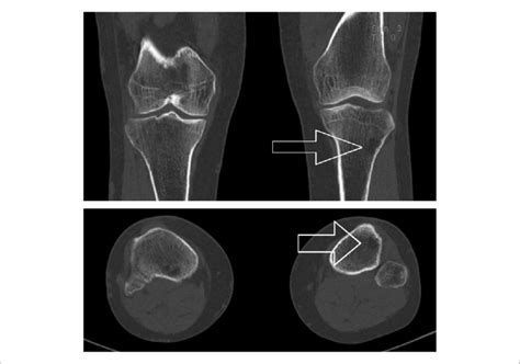 Left Sided Proximal Tibia Bone Autograft Complete Remodeling After 25 Download Scientific