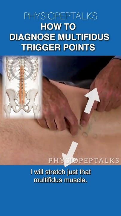How To Diagnose Multifidus Trigger Points Multifidustriggerpoints