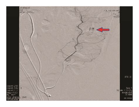 Super Selective Embolization A Before And B After Coil Deployment Download Scientific