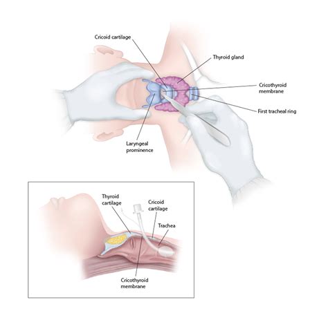 Surgical Airway Critical Care Medicine Merck Manual Professional