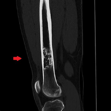 비골화성 섬유종 Non Ossifying Fibroma 원인 및 치료
