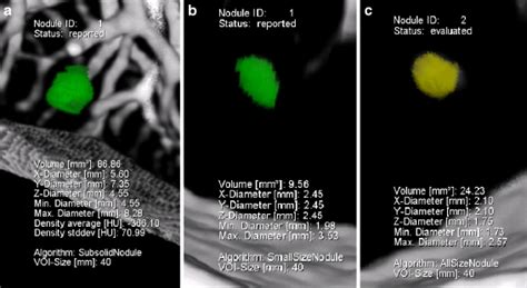 The Same Nodule Analysed At The Same Time With The Subsolid A Small Download Scientific