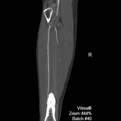 Left Distal Popliteal Trifurcation Embolus With Segmental Occlusion Download Scientific Diagram