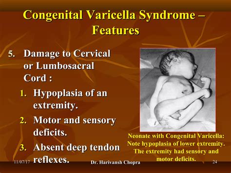 Chickenpox Varicella Dr Harivansh Chopra Ppt
