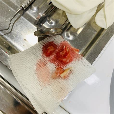 약혐 매복 사랑니 뽑고 왔다 스압 세줄요약있음 유머 움짤 이슈 에펨코리아