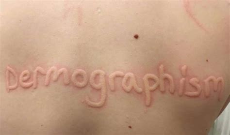 Dermatographic Urticaria Causes Symptoms Treatment And Prevention