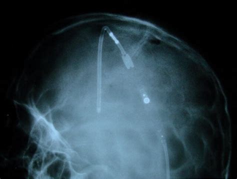 Codman Programmable Shunt Brain