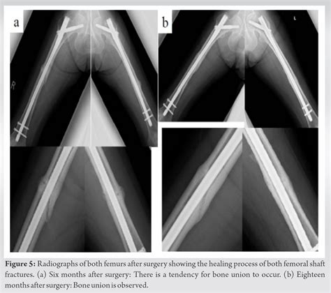 Impending Atypical Femoral Fracture On The Contralateral Side