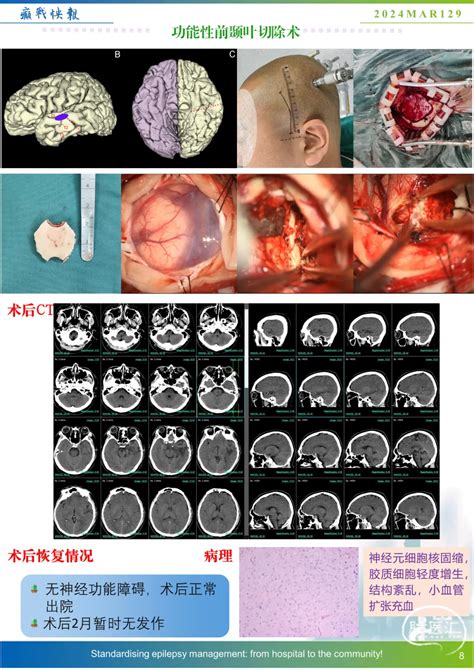 【癫战快报】第127期：功能性前颞叶切除术治疗进展性颞叶癫痫一例 脑医汇