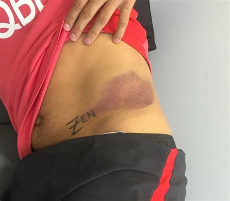 Hip Pointer Injury Causes Symptoms Diagnosis Treatment And Recovery Time