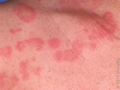 Stress Rash Causes Pictures And Treatment Goodrx