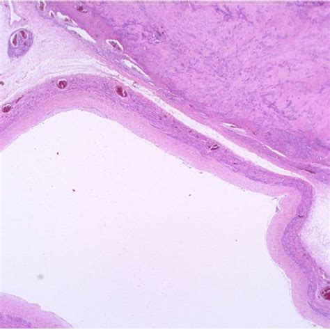 Ct Scan Showing Multiloculated Myometrial Cyst Distinct From The Download Scientific Diagram