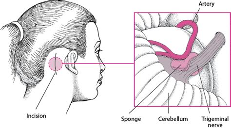 Trigeminal Neuralgia Neurologic Disorders Msd Manual Professional Edition
