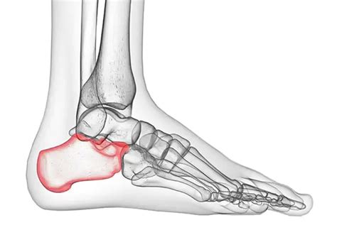 Solved Talus Sustentaculum Tali Subkalar Calcaneus From K Orif Screw