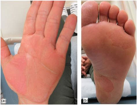 Palmoplantar Keratoderma Climactericum Successfully Treated With