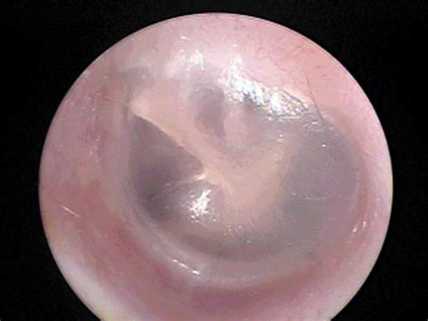Normal Tympanic Membrane Vs Bulging