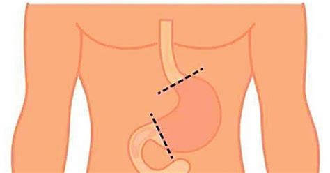 위 점막이 장 점막으로 변하는 ‘장상피화생 위암 발생률 10배 높인다