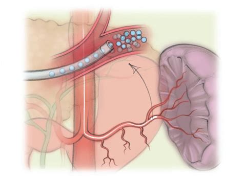 Partial Splenic Embolization — The Interventional Initiative