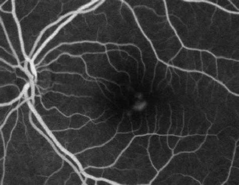 Early Fluorescein Angiogram Os Retina Image Bank