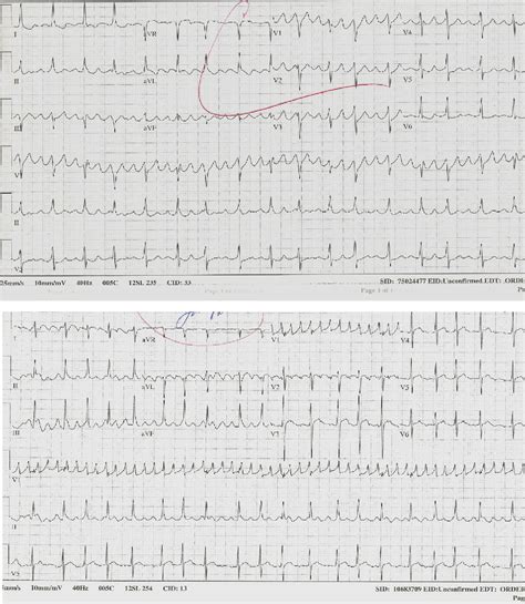 Figure 1 3 From Giant Flutter Waves In Ecg Lead V1 A Marker Of
