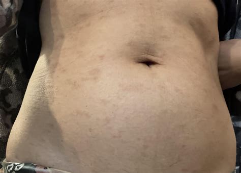 Hyperpigmentation After Pr Rpityriasisrosea