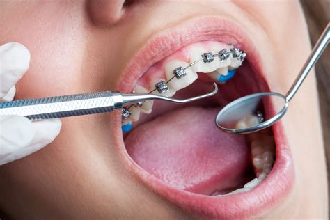 Surgical Orthodontics and Other Straightening Options - Belmar Orthodontics