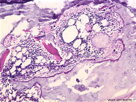 Doubled Enchondroma Set Classification Dataset And Pre Trained Model By Enchond Vs Chondrosarc