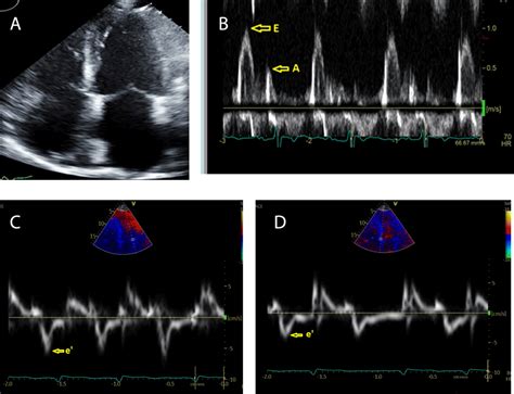 Restrictive Cardiomyopathy Esc