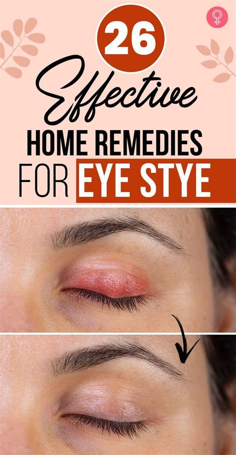 How To Get Rid Of A Stye 26 Home Remedies And Precautions Artofit