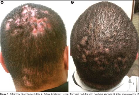 Dissecting Cellulitis Of The Scalp Treatment Quotes Update Viral