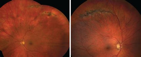 Atrophic Retinal Hole