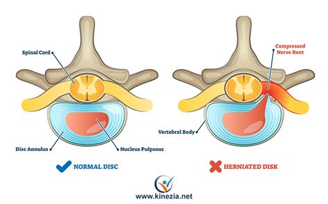 Дискова херния Всичко което трябва да знаете за да се избегне операцията Кинезия