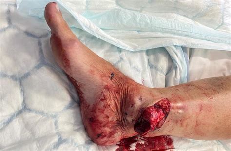 Gustilo Anderson Type Iiia Open Tibial Fracture Download Scientific Diagram