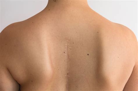 Scoliosis Surgery Scar