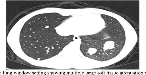 Figure 1 From Thoracic Primitive Neuro Ectodermal Tumor With Superior