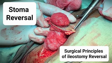 Ileostomy Reversal