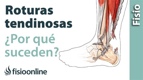 Roturas Tendinosas Causas Y Evolución Fisioonline
