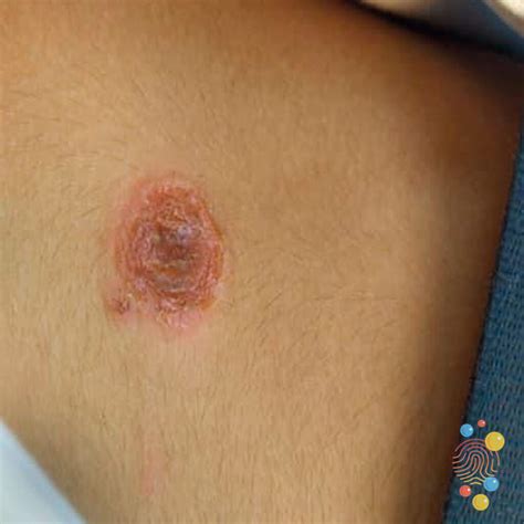 Ecthyma Gangrenosum Skin Deep