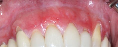 White Spots On Gums From Smoking