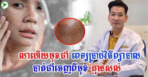 មុខជាំអស់បារម្ភហើយ គ្រូពេទ្យប្រាប់វិធីព្យាបាលមានប្រសិទ្ធភាពខ្ពស់ បាត់ជាំចេញពីមុខគ្មានសល់