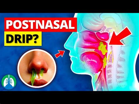 Pharynx Drip Post Nasal