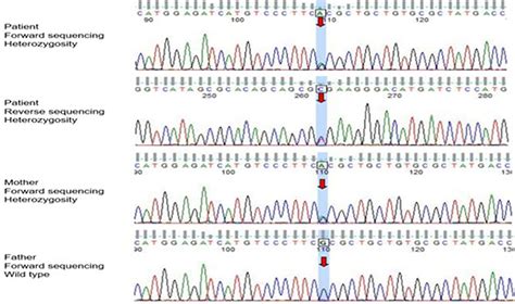A Case Of Thyroid Hormone Resistance Syndrome With A Novel Mutation C