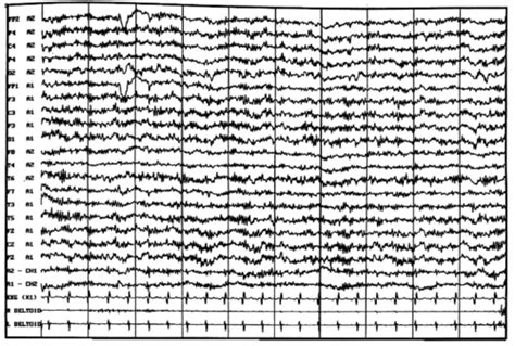 EEG Flashcards Quizlet
