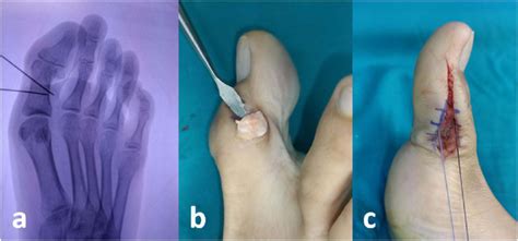 A Akin Osteotomy Design B Ossicle Removal And C Medial Download Scientific Diagram
