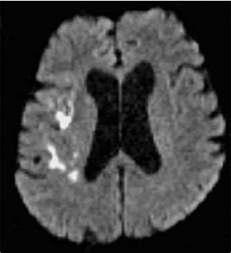 A Perfusion Diffusion Mismatch In The Right Mca Diffusion Weighted Download Scientific