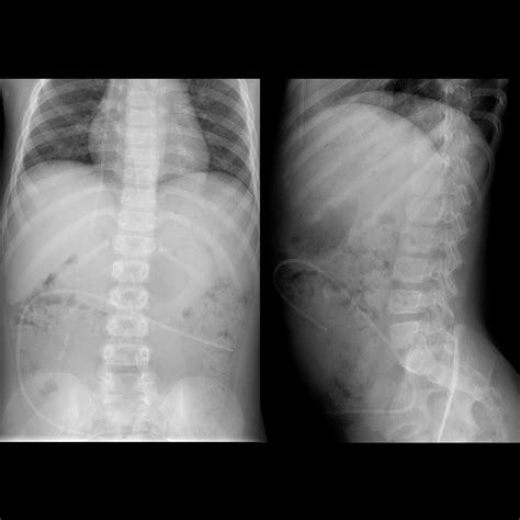 School Ager At Yearly Vp Shunt Checkup Without Any Symptoms Pediatric