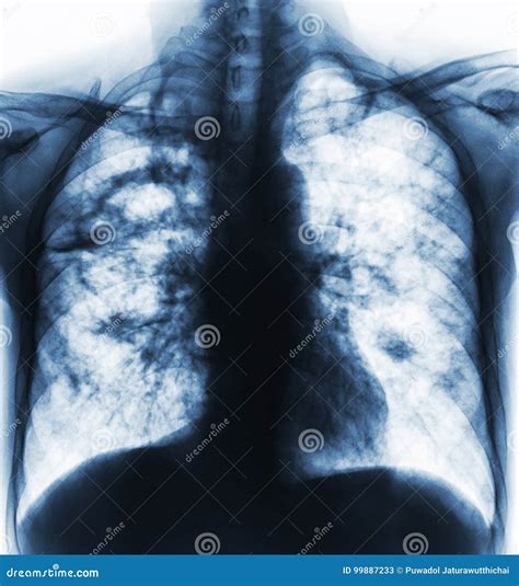 Pulmonary Tuberculosis Film X Ray Of Chest Show Cavity At Right Lung And Interstitial