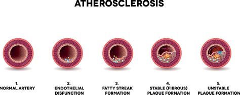 Pembentukan Aterosklerosis Ilustrasi Stok Unduh Gambar Sekarang Aterosklerosis Pembuluh