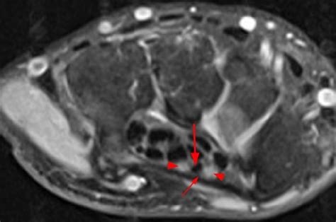 Persistent Median Artery Radsource