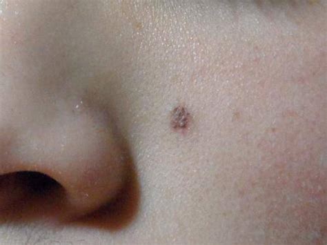 痦子变大鼓起来了 痦子变的图片 手上长痦子 大山谷图库